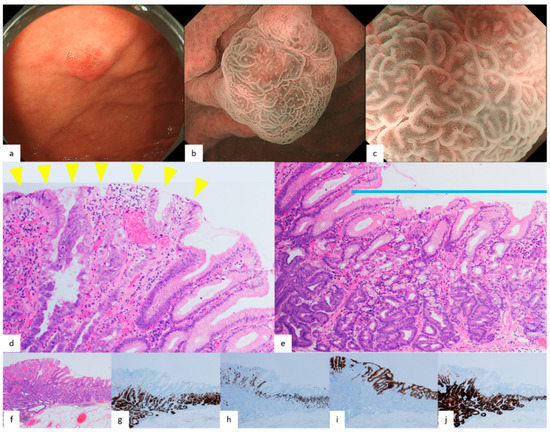 Endoscopic Features of Gastric Epithelial Neoplasm of Fundic Gland ...