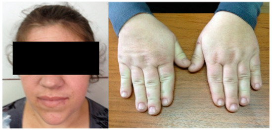 Approach of Acromegaly during Pregnancy