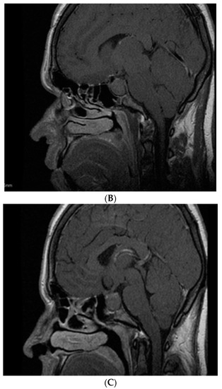 Approach of Acromegaly during Pregnancy