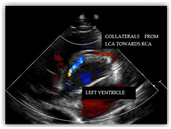 Challenging Diagnosis of Anomalous Origin of the Right Coronary Artery ...