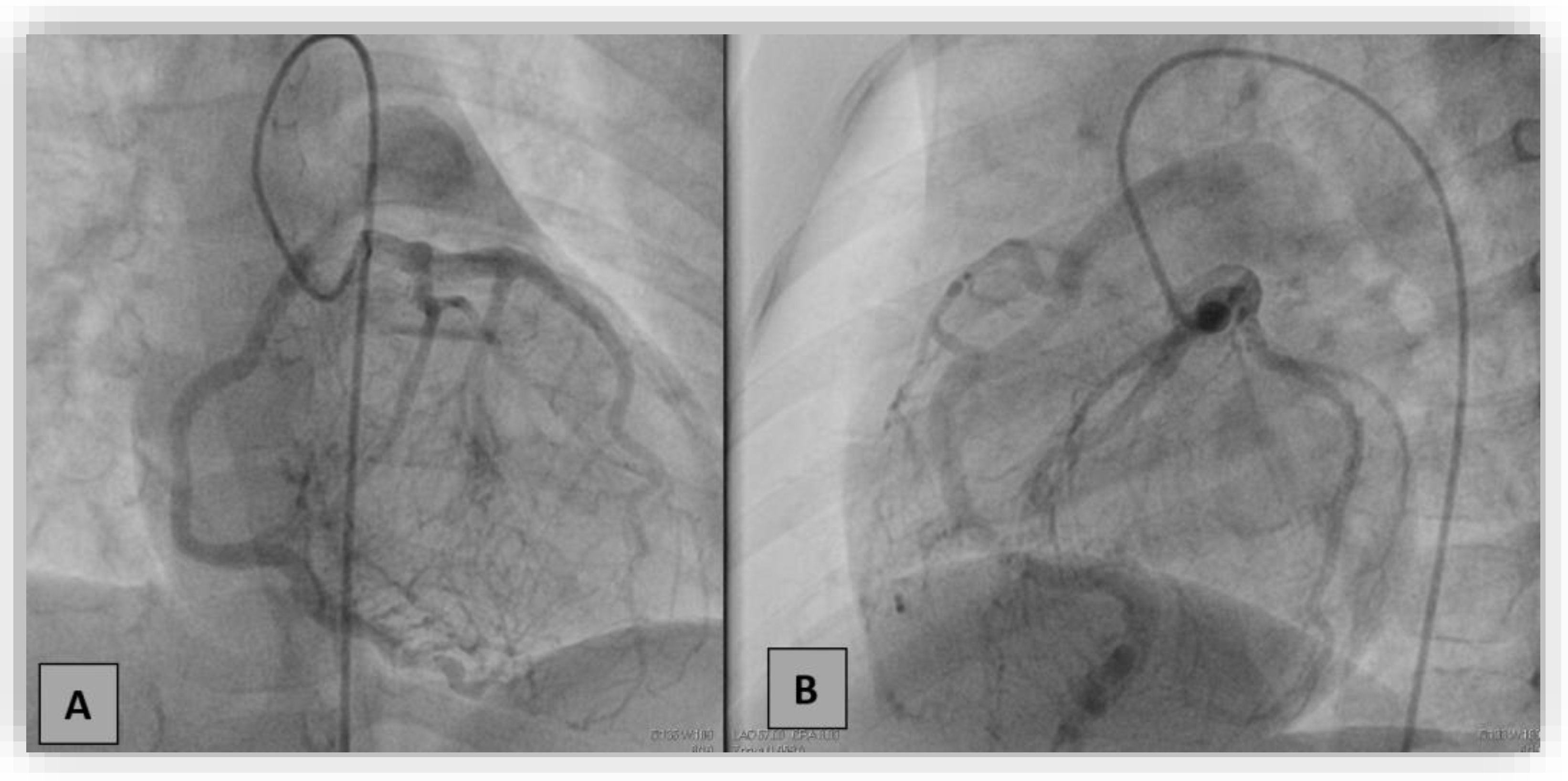 Challenging Diagnosis of Anomalous Origin of the Right Coronary Artery ...