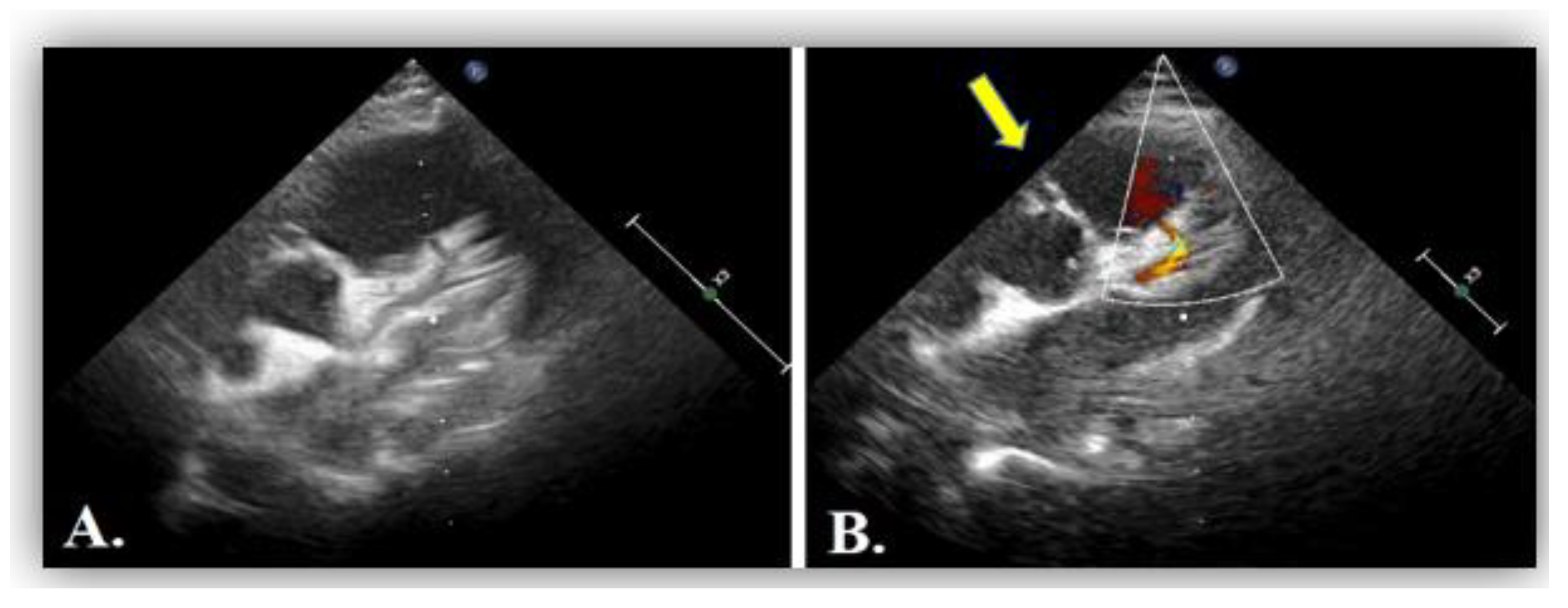 Challenging Diagnosis of Anomalous Origin of the Right Coronary Artery ...