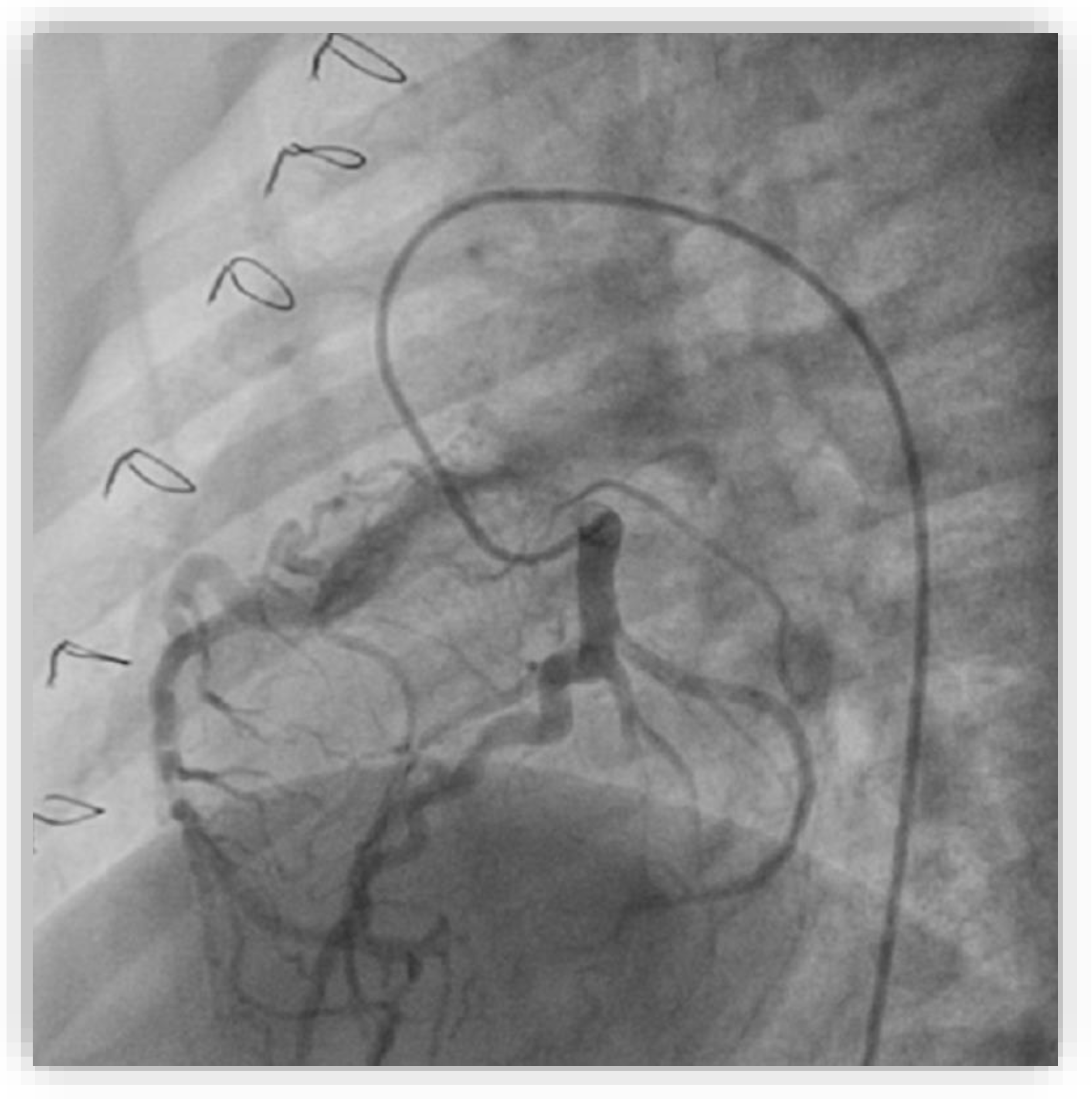 Challenging Diagnosis of Anomalous Origin of the Right Coronary Artery ...
