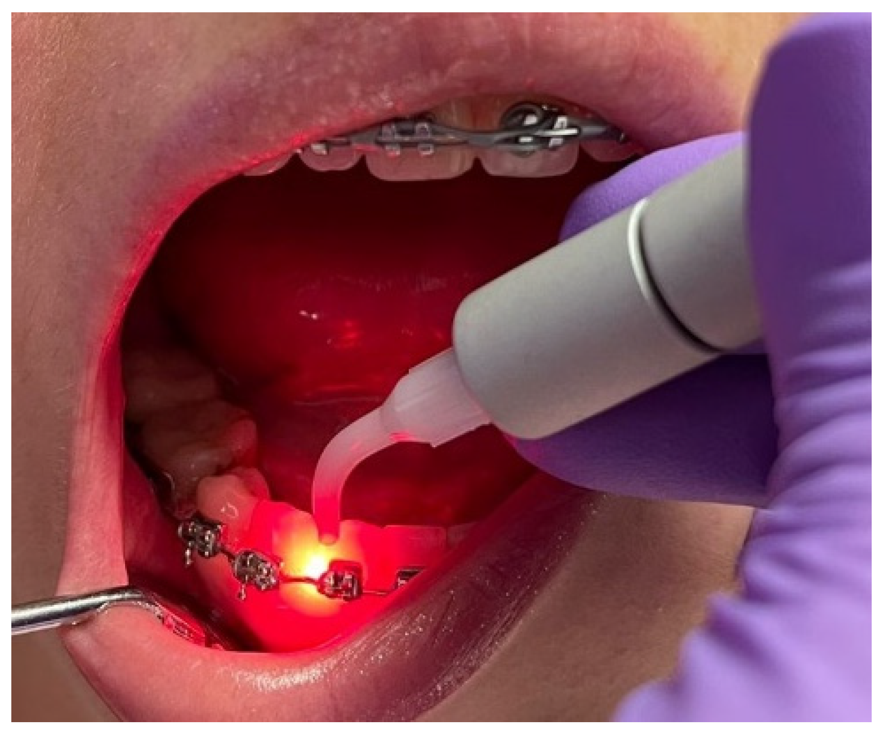 Diagnostics | Free Full-Text | Effects of Laser Therapy on Periodontal ... Diagnostics | Free Full-Text | Effects of Laser Therapy on Periodontal ...