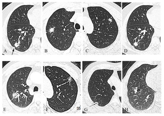 Qualitative (and Quantitative) Values of the Lung-RADS and Computed ...