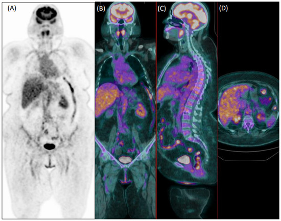[18F]FDG PET/CT in Large Vessel Vasculitis: The Impact of Expertise and Confounders on Image ...
