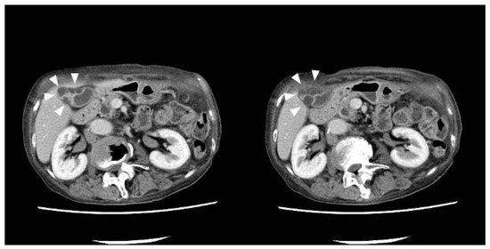 Diagnostics | Free Full-Text | A Case of Early-Stage Gallbladder Cancer ...