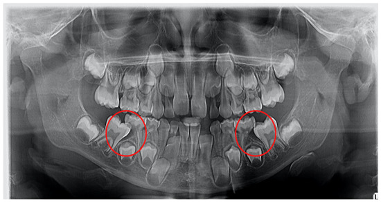 Ectopic Eruption of First Permanent Molars in Children from North ...