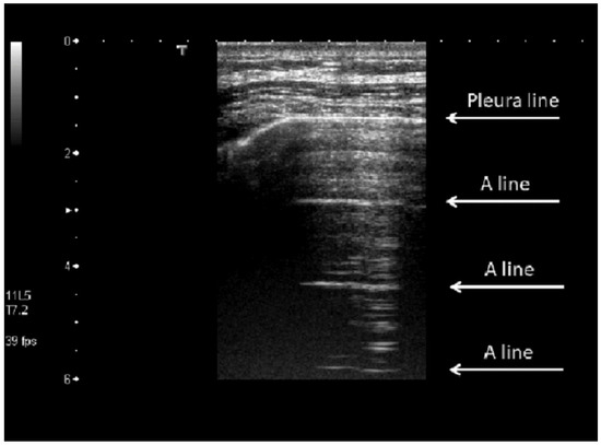 B-Lines Lung Ultrasonography Simulation Using Finite Element Method