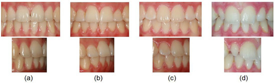 Morphological Diversity of Permanent Maxillary Lateral Incisors and ...