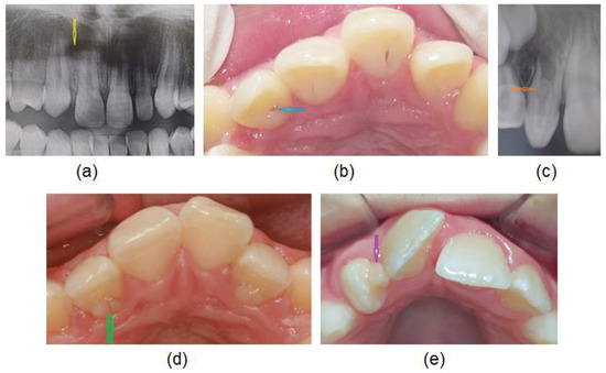 Morphological Diversity of Permanent Maxillary Lateral Incisors and ...