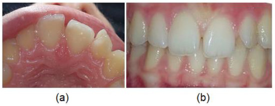 Morphological Diversity of Permanent Maxillary Lateral Incisors and ...