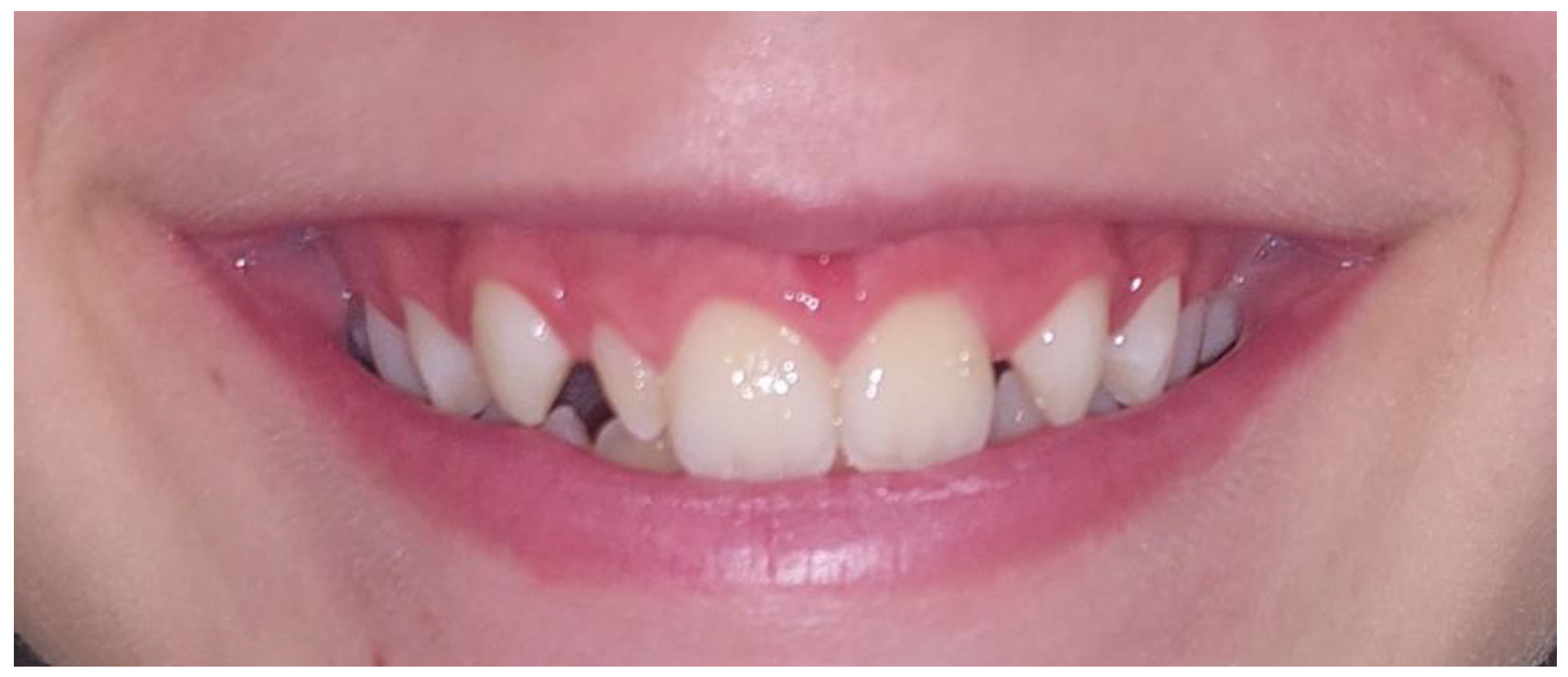Morphological Diversity of Permanent Maxillary Lateral Incisors and ...