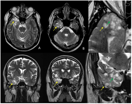 New Imaging Features of Multinodular and Vacuolating Neuronal Tumor ...