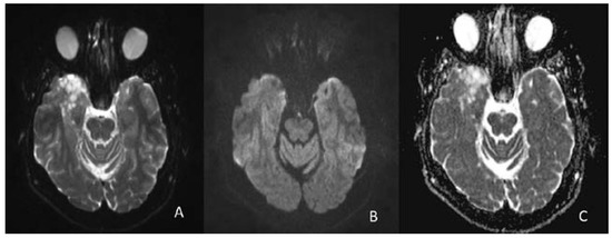 New Imaging Features of Multinodular and Vacuolating Neuronal Tumor ...