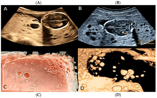 Placental and Umbilical Cord Anomalies Diagnosed by Two- and Three ...