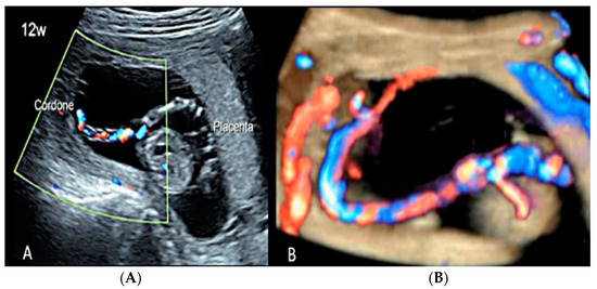 Placental and Umbilical Cord Anomalies Diagnosed by Two- and Three ...