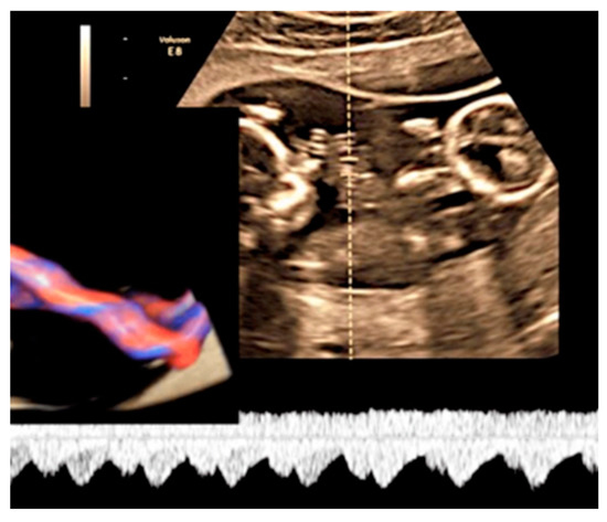 Placental and Umbilical Cord Anomalies Diagnosed by Two- and Three ...