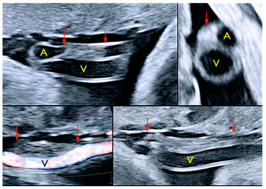 Placental and Umbilical Cord Anomalies Diagnosed by Two- and Three ...