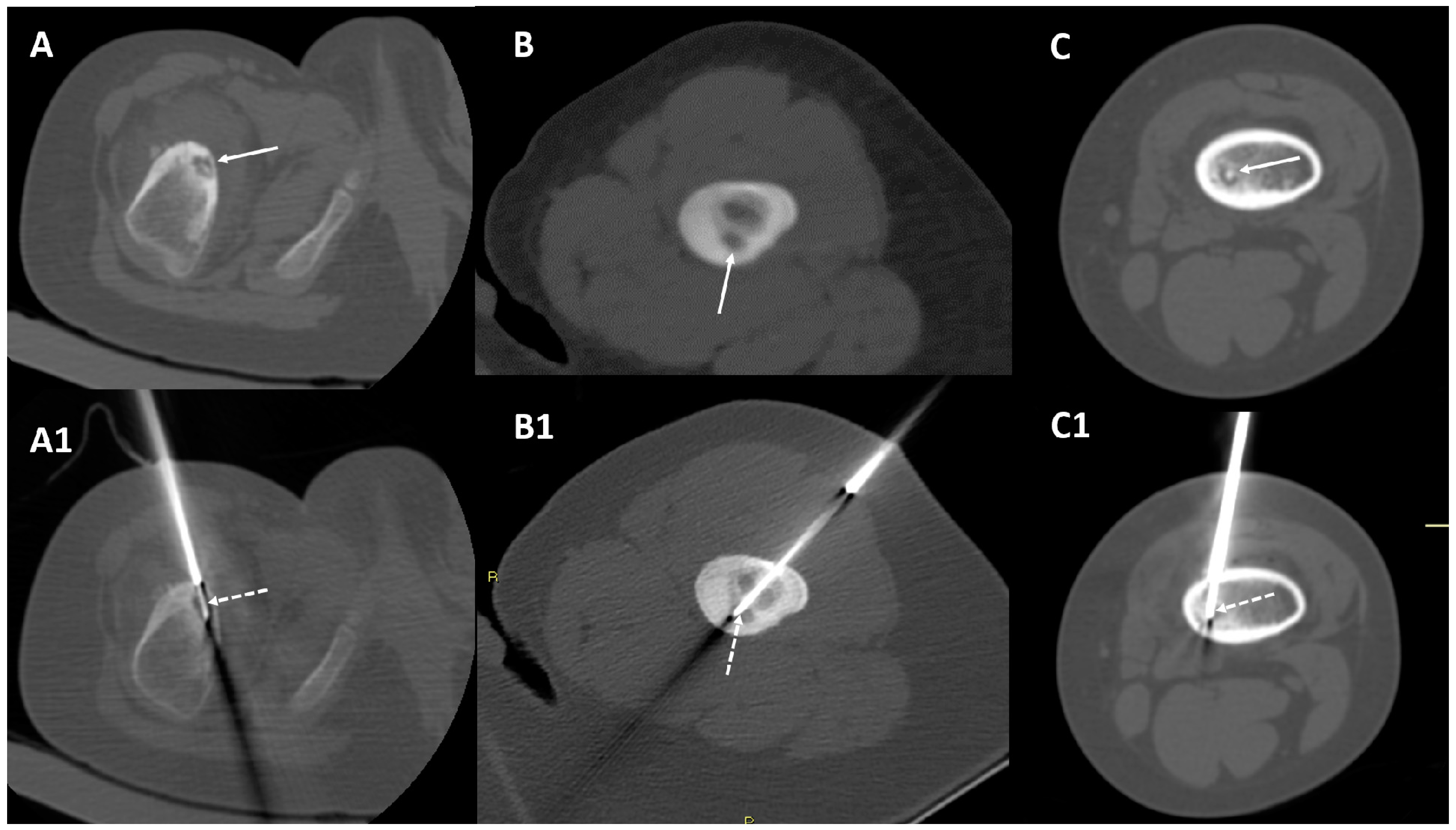 Ct Guided Radiofrequency Thermal Ablation For The Treatment Of Atypical
