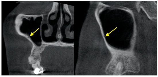 The Use of CBCT in Evaluating the Health and Pathology of the Maxillary ...