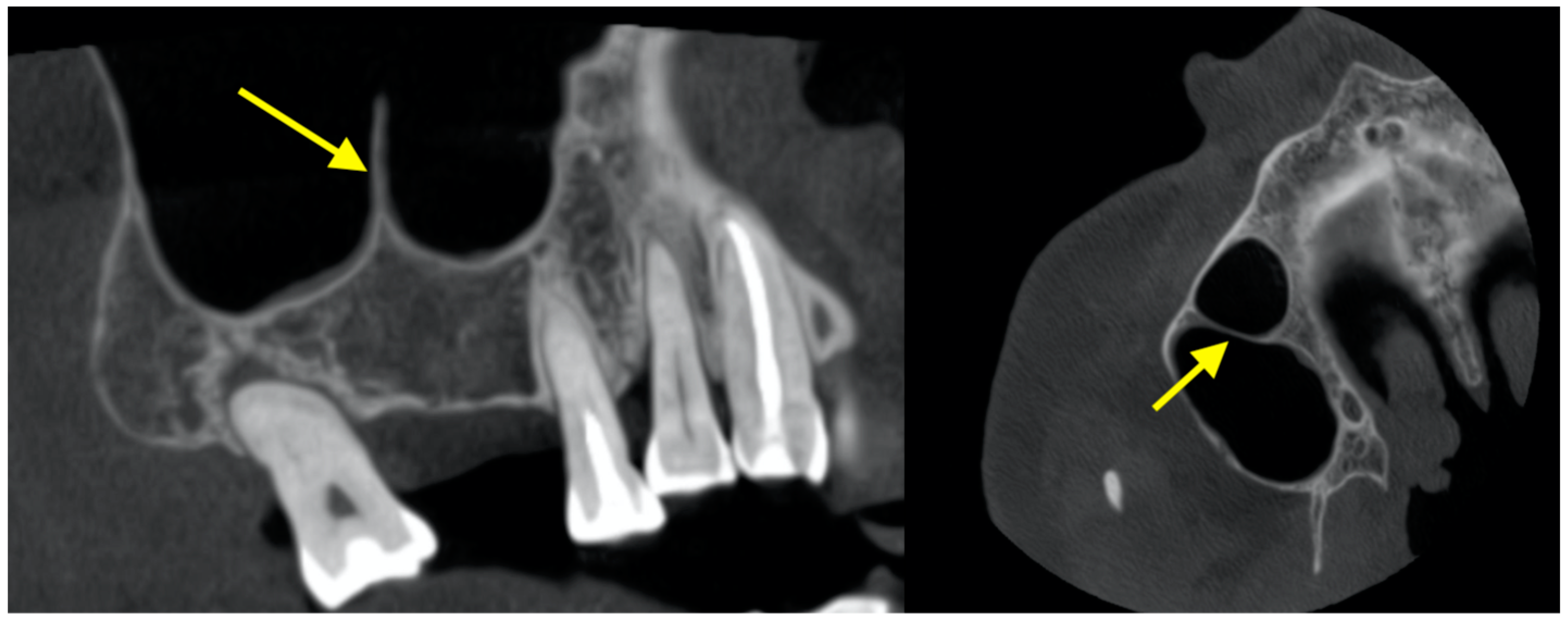 The Use of CBCT in Evaluating the Health and Pathology of the Maxillary ...