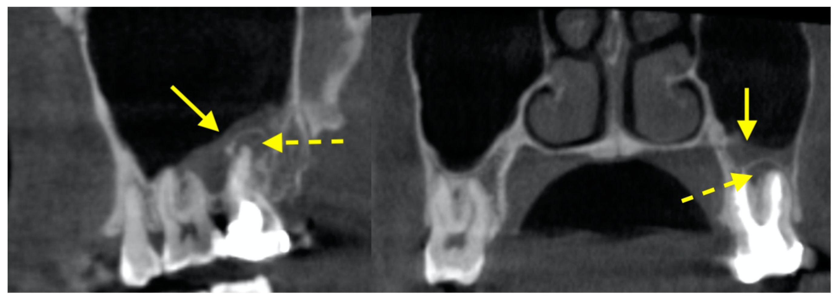 The Use of CBCT in Evaluating the Health and Pathology of the Maxillary ...