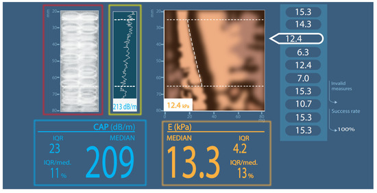 Ultrasound-Based Diagnostic Methods: Possible Use in Fatty Liver ...