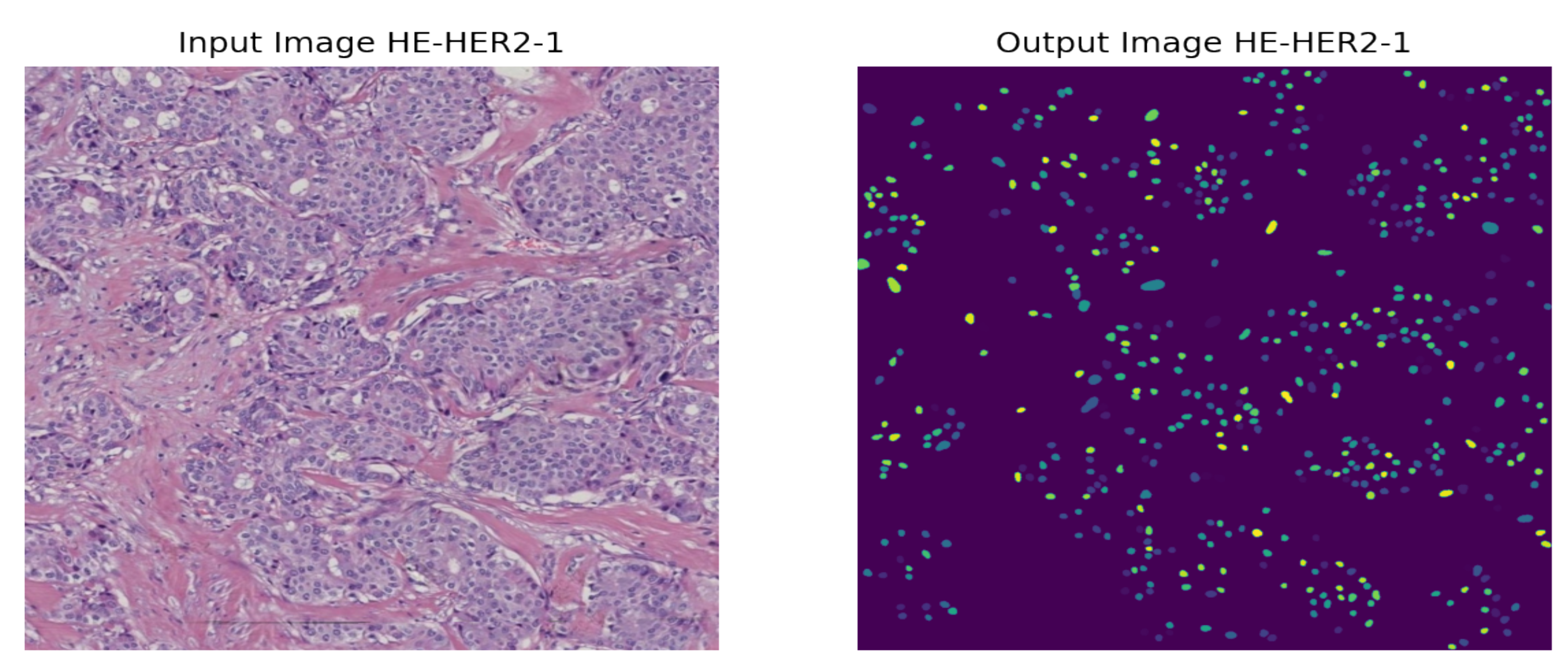 Strategies for Enhancing the Multi-Stage Classification Performances of HER2 Breast Cancer from ...