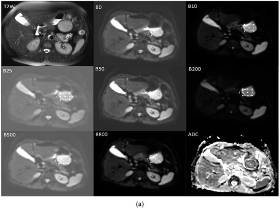 Diagnostics | Free Full-Text | The Utility of Conventional CT, CT ...