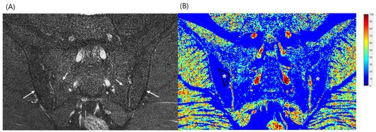 Water Fraction Ratio of the Sacroiliac Joint Subchondral Bone Marrow in ...