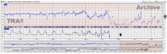 Umbilical Cord Prolapse—Interesting CTG Traces