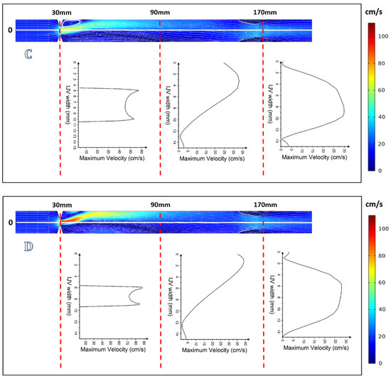 Results of Numerical Modeling of Blood Flow in the Internal Jugular ...