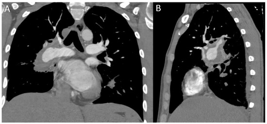 Behçet’s Disease: A Radiological Review of Vascular and Parenchymal ...