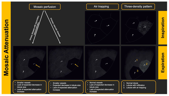 Hypersensitivity Pneumonitis: A Pictorial Review Based on the New ATS ...