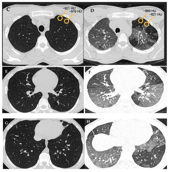 Hypersensitivity Pneumonitis: A Pictorial Review Based on the New ATS ...