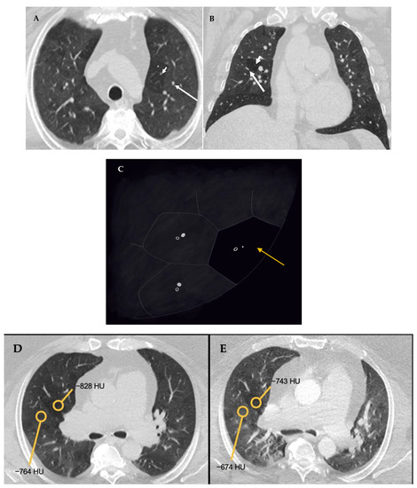 Hypersensitivity Pneumonitis: A Pictorial Review Based on the New ATS ...