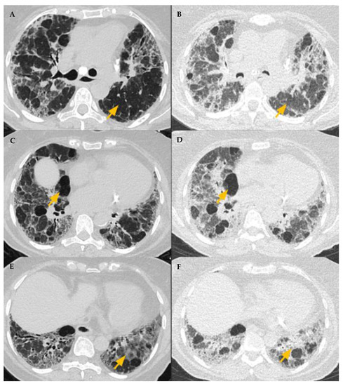 Hypersensitivity Pneumonitis: A Pictorial Review Based on the New ATS ...