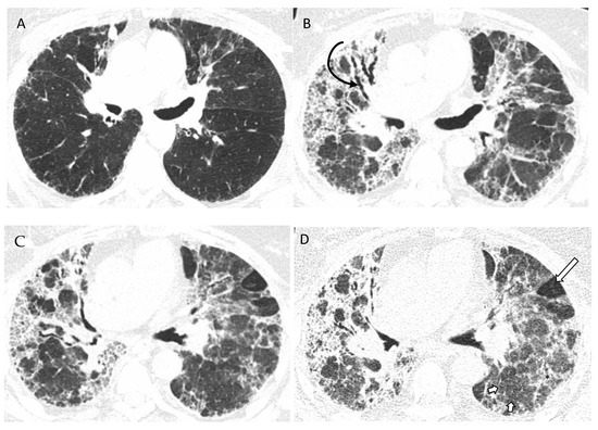 Hypersensitivity Pneumonitis: A Pictorial Review Based on the New ATS ...