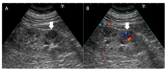Hyaline Vascular Type of Unicentric Castleman Disease in a Kidney with ...