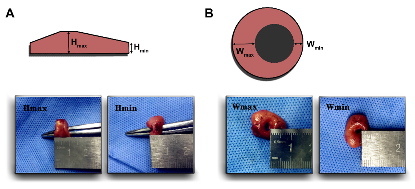 Anastomotic Rings and Inflammation Values as Biomarkers for Leakage of ...