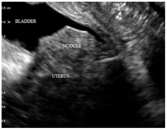 Transvaginal Ultrasound in the Diagnosis and Assessment of ...