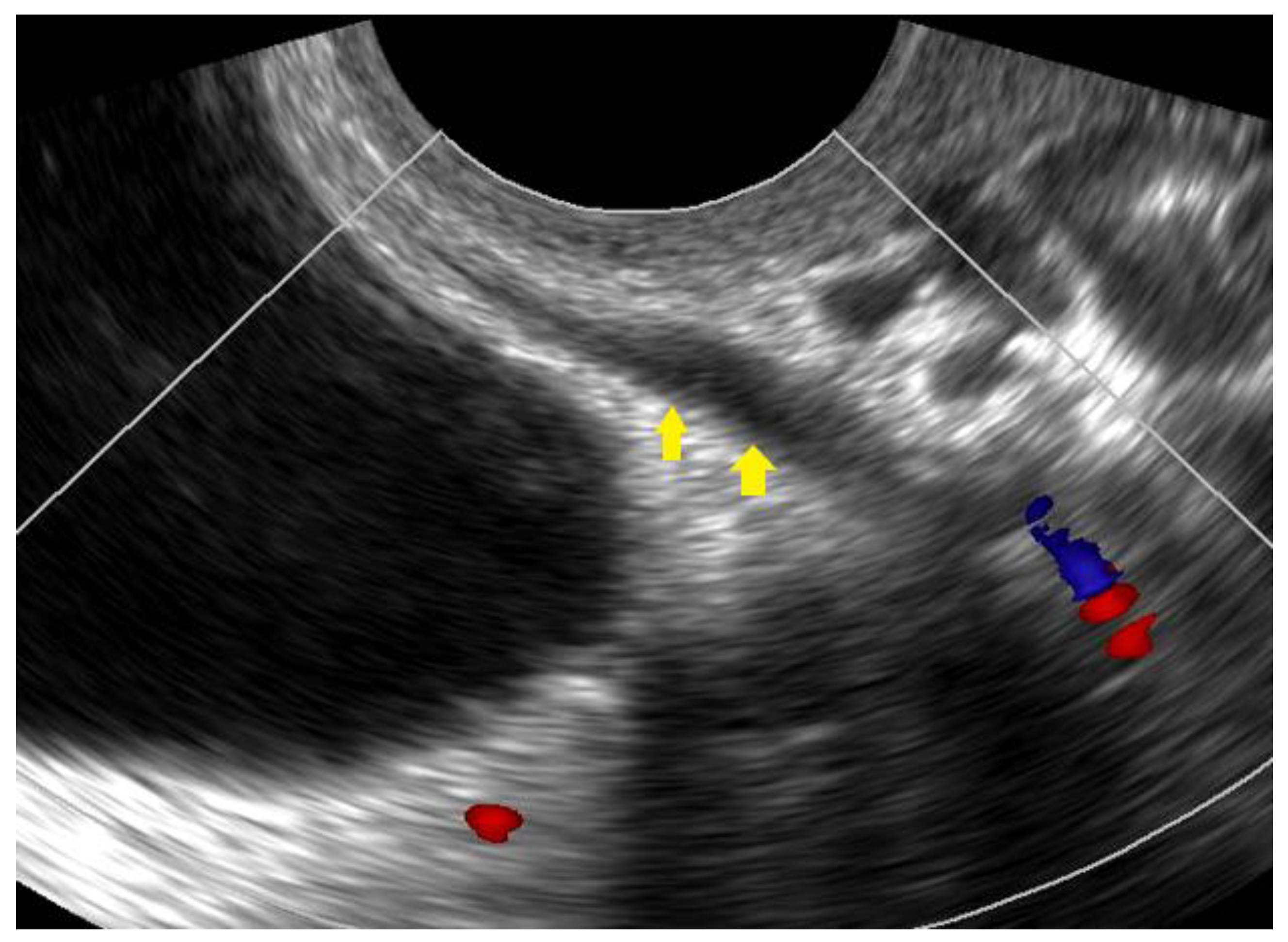 Diagnostics Free Full Text Transvaginal Ultrasound In The Diagnosis