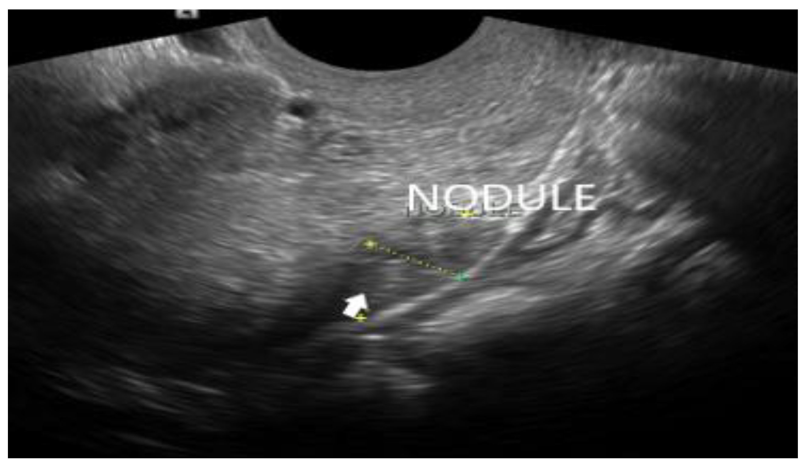 Diagnostics Free Full Text Transvaginal Ultrasound In The Diagnosis