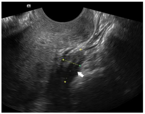 Transvaginal Ultrasound in the Diagnosis and Assessment of ...