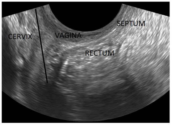 Diagnostics Free Full Text Transvaginal Ultrasound In The Diagnosis