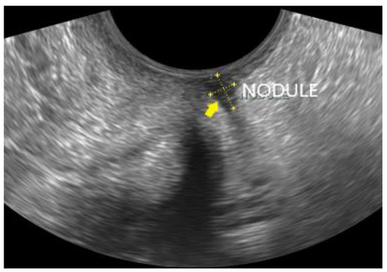 Transvaginal Ultrasound in the Diagnosis and Assessment of ...