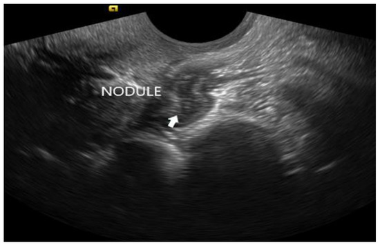 Transvaginal Ultrasound in the Diagnosis and Assessment of ...