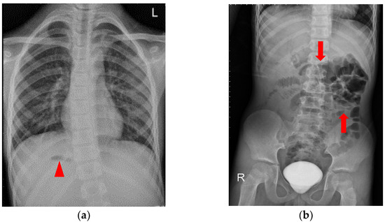 Splenic Torsion in Heterotaxy Syndrome with Left Isomerism: A Case ...