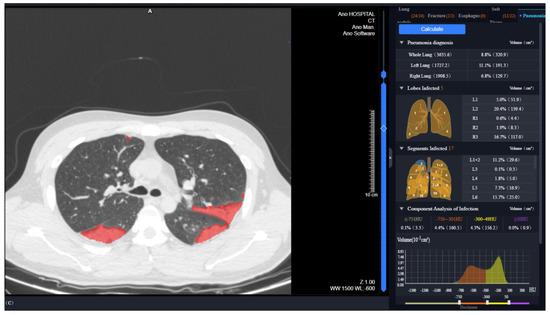 Well-Aerated Lung and Mean Lung Density Quantified by CT at Discharge ...